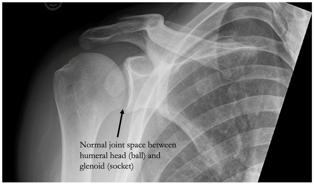 Shoulder Arthritis — Michael Fu, MD - HSS Shoulder Surgery
