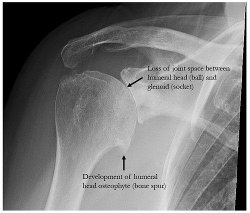 Shoulder Arthritis — Michael Fu, MD - HSS Shoulder Surgery