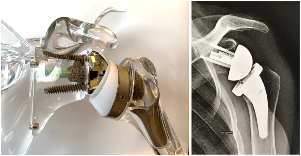 Total Shoulder Replacement (Anatomic and Reverse) - HSS Shoulder ...