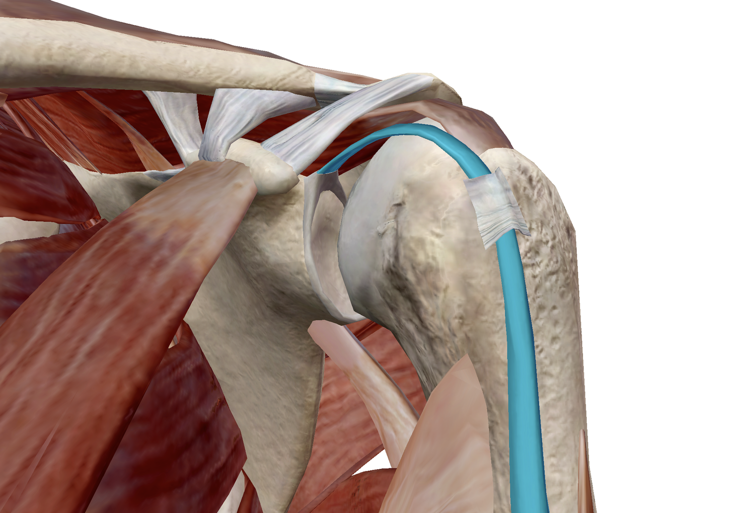 Shoulder Biceps Tenodesis Surgery - HSS Shoulder Specialist Surgeon in ...