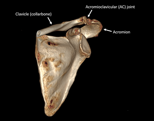 Shoulder Acromioclavicular (AC) Joint Resection - HSS Shoulder ...