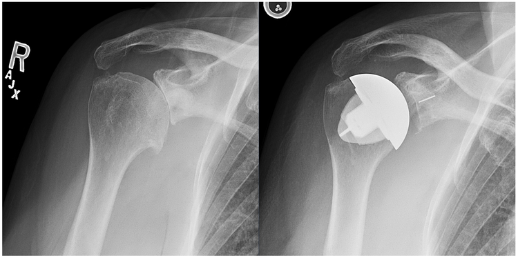 Patient-Specific Total Shoulder Replacement Surgical Planning — Michael ...