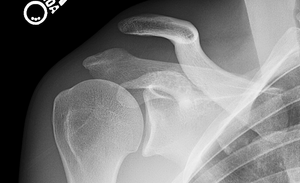 AC Joint Injury Shoulder Separation — Michael Fu, MD - HSS Shoulder Surgery