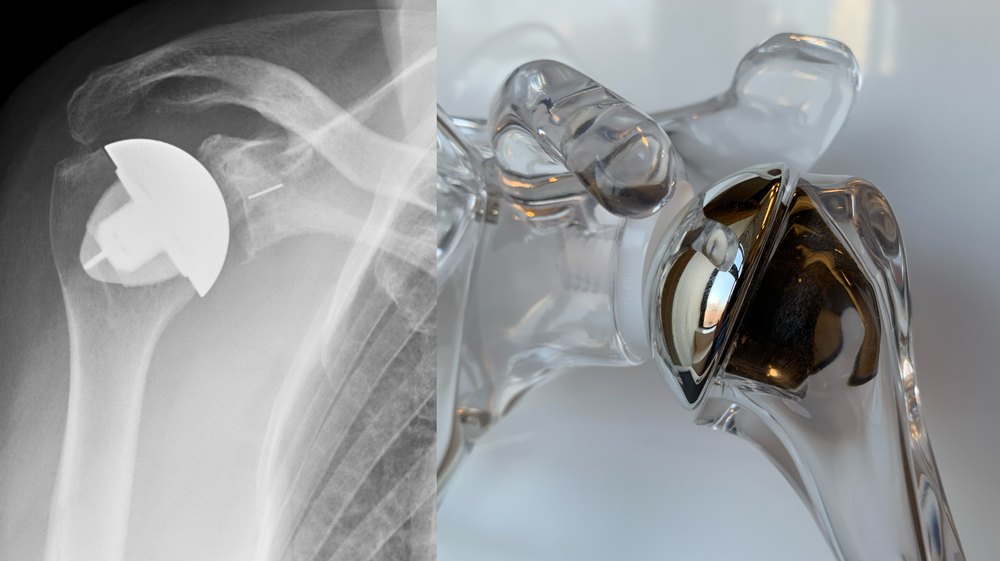 Total Shoulder Replacement (Anatomic and Reverse) - HSS Shoulder ...