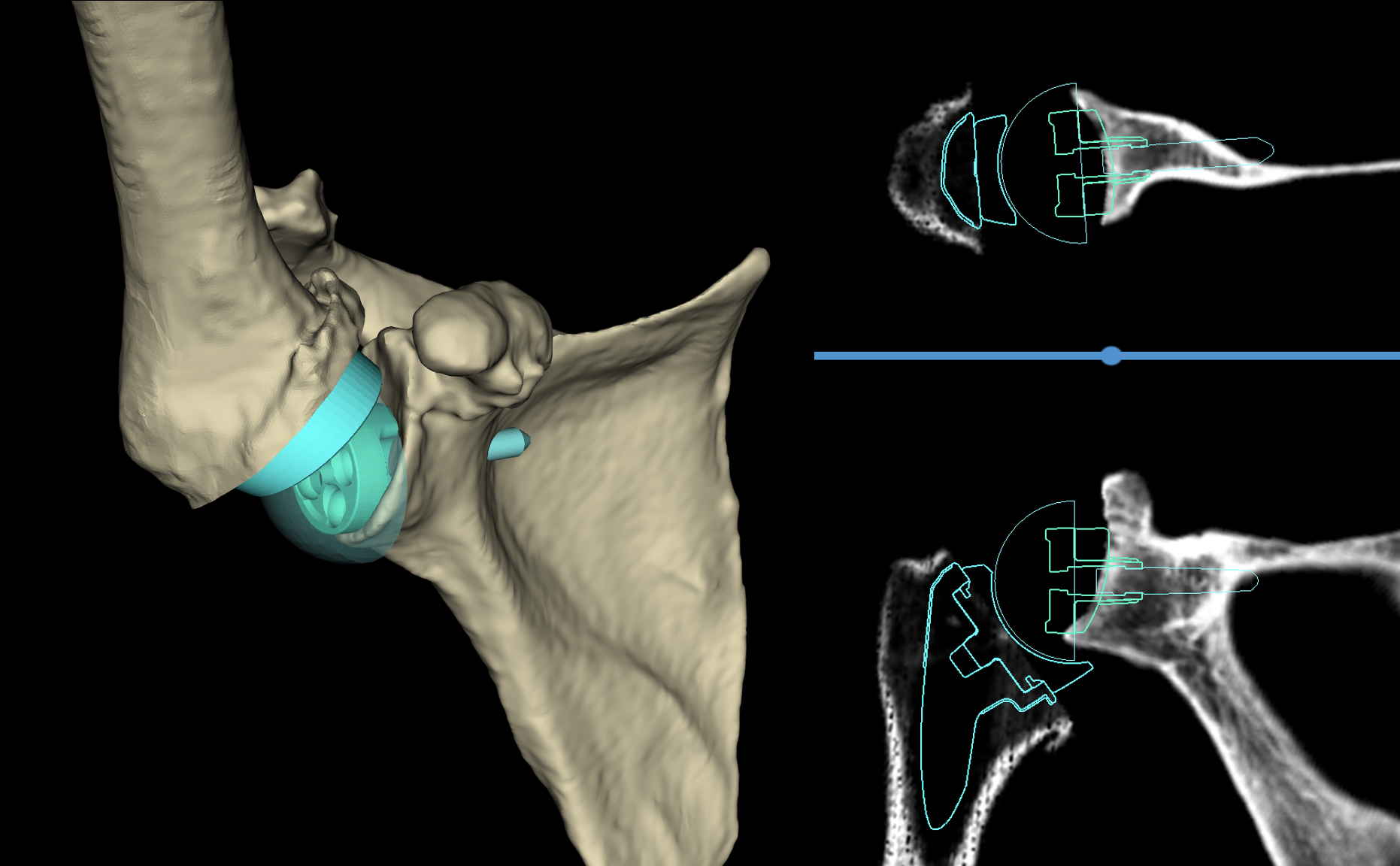 Blog — Michael Fu, MD - HSS Shoulder Surgery