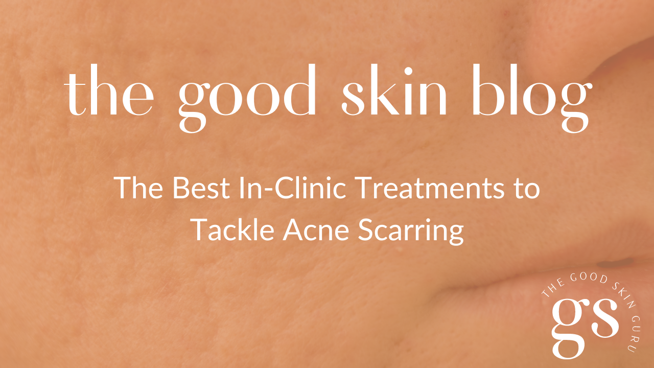 Treatments to Tackle Acne Scarring — The Good Skin Guru