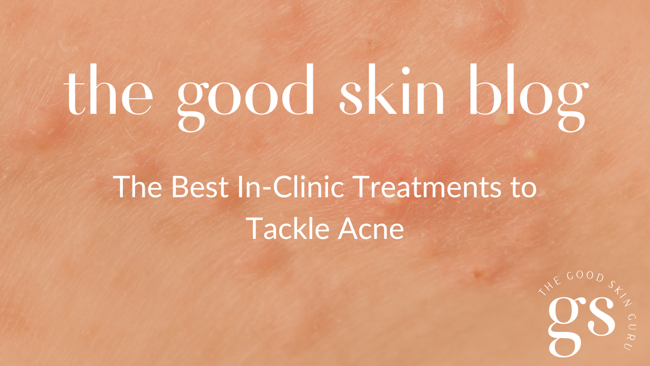 Treatments to Tackle Acne — The Good Skin Guru