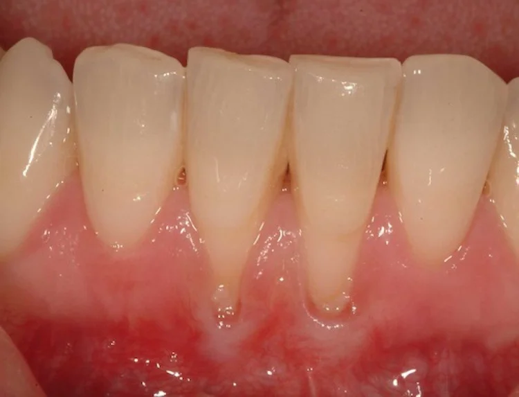 Understanding Tooth Recession: Causes, Prevention, and Treatment ...