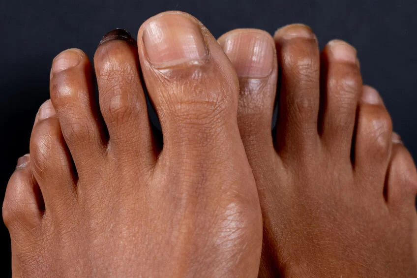 Recognizing Claw Toe Before It s Too Late Dr James Ricketti Associates Recognizing Claw Toe Before It s Too Late Dr James Ricketti Associates