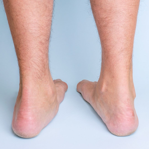 Fast Facts on Fallen Arch or Flat Feet — Dr. James Ricketti & Associates