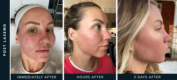 The Truth About LaseMD: Before and After — That Boujee Bohemian ...