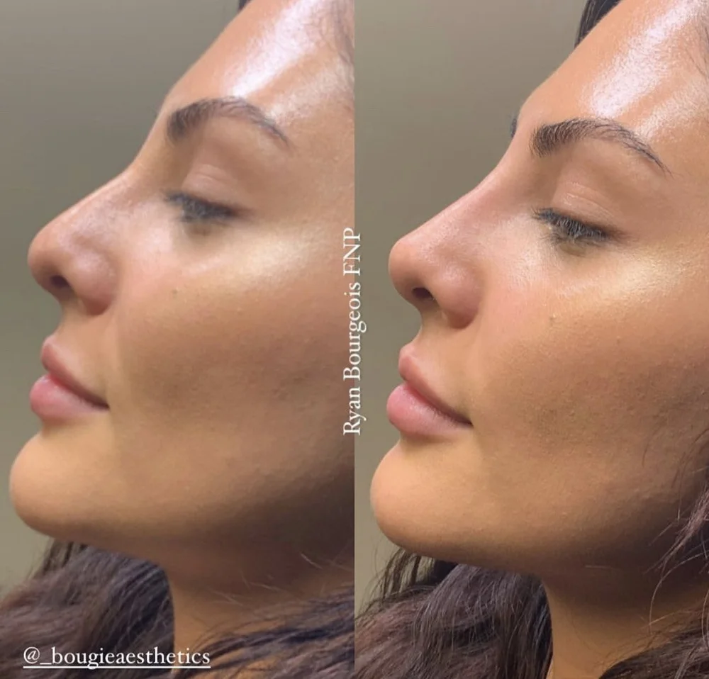 Radiesse Before And After Nose
