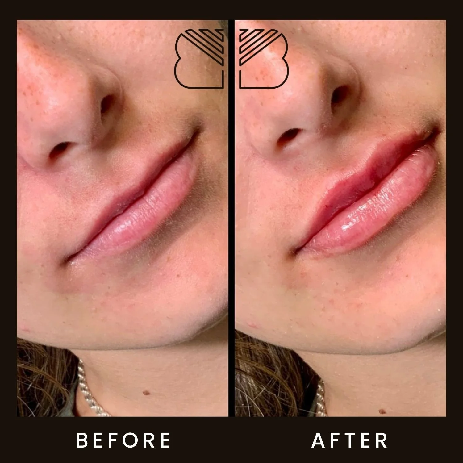 Dermal Fillers Fort Worth, TX | Lip Filler | Bougie Aesthetics