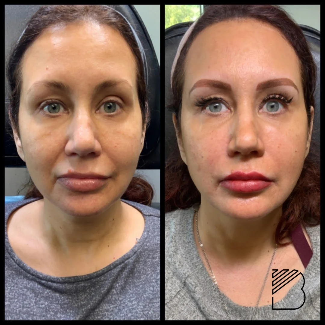 How Sculptra Benefits the Face AND the Butt
