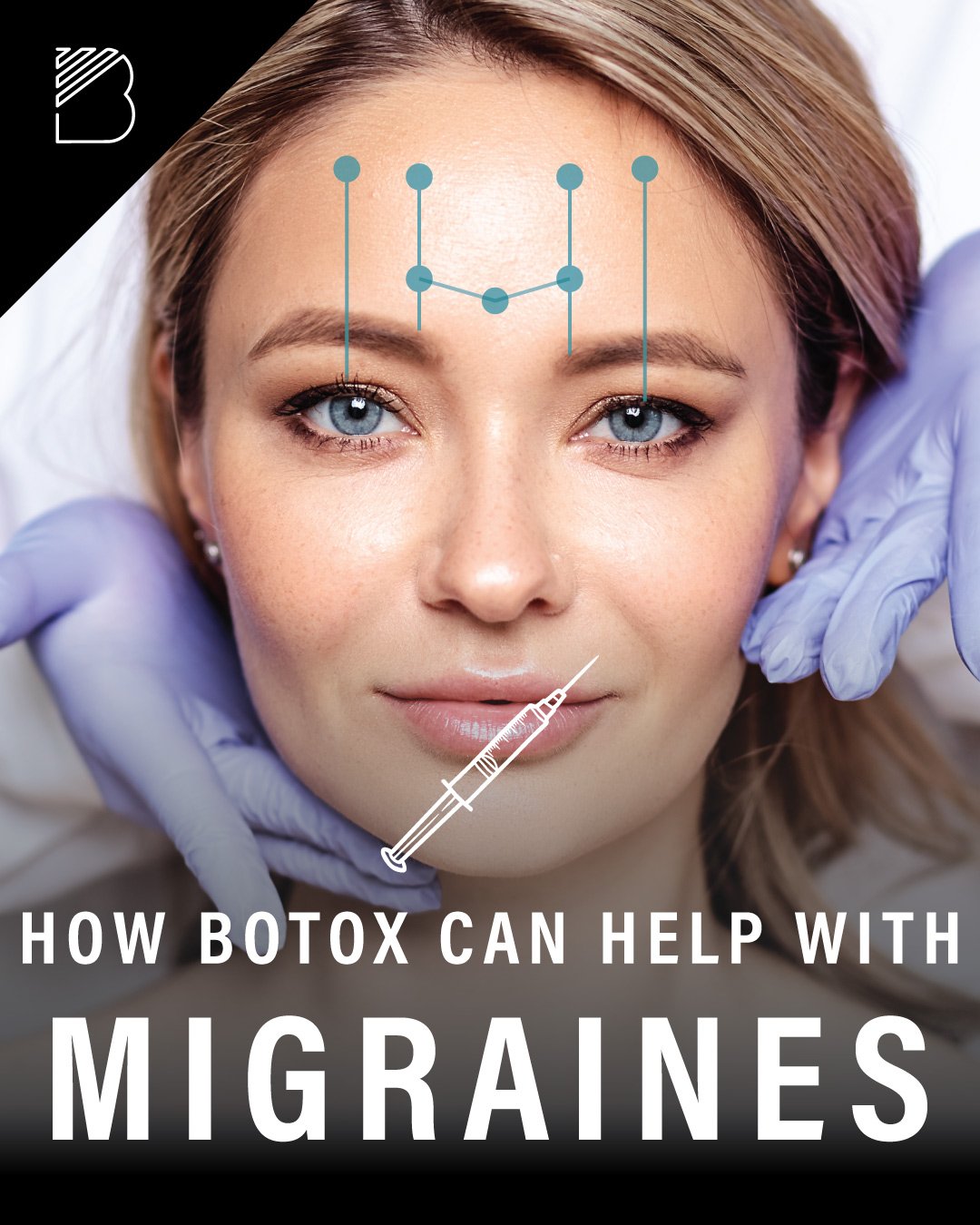 How Much is Botox for Migraines?