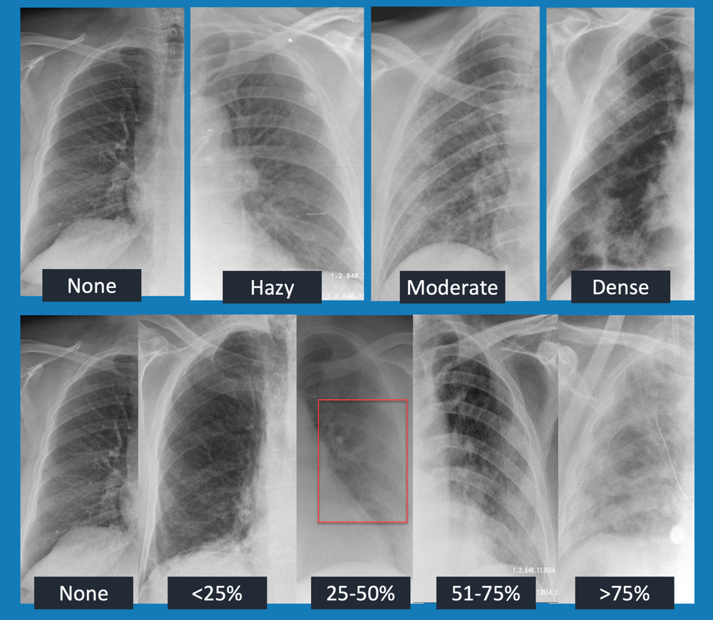 Annotations — MIDRC