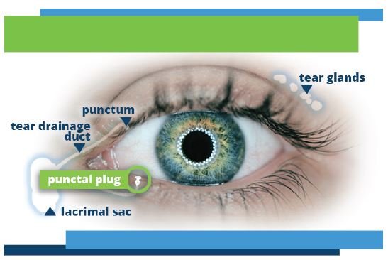 Hilco Vision Punctal - Coming Soon! — eyetalk
