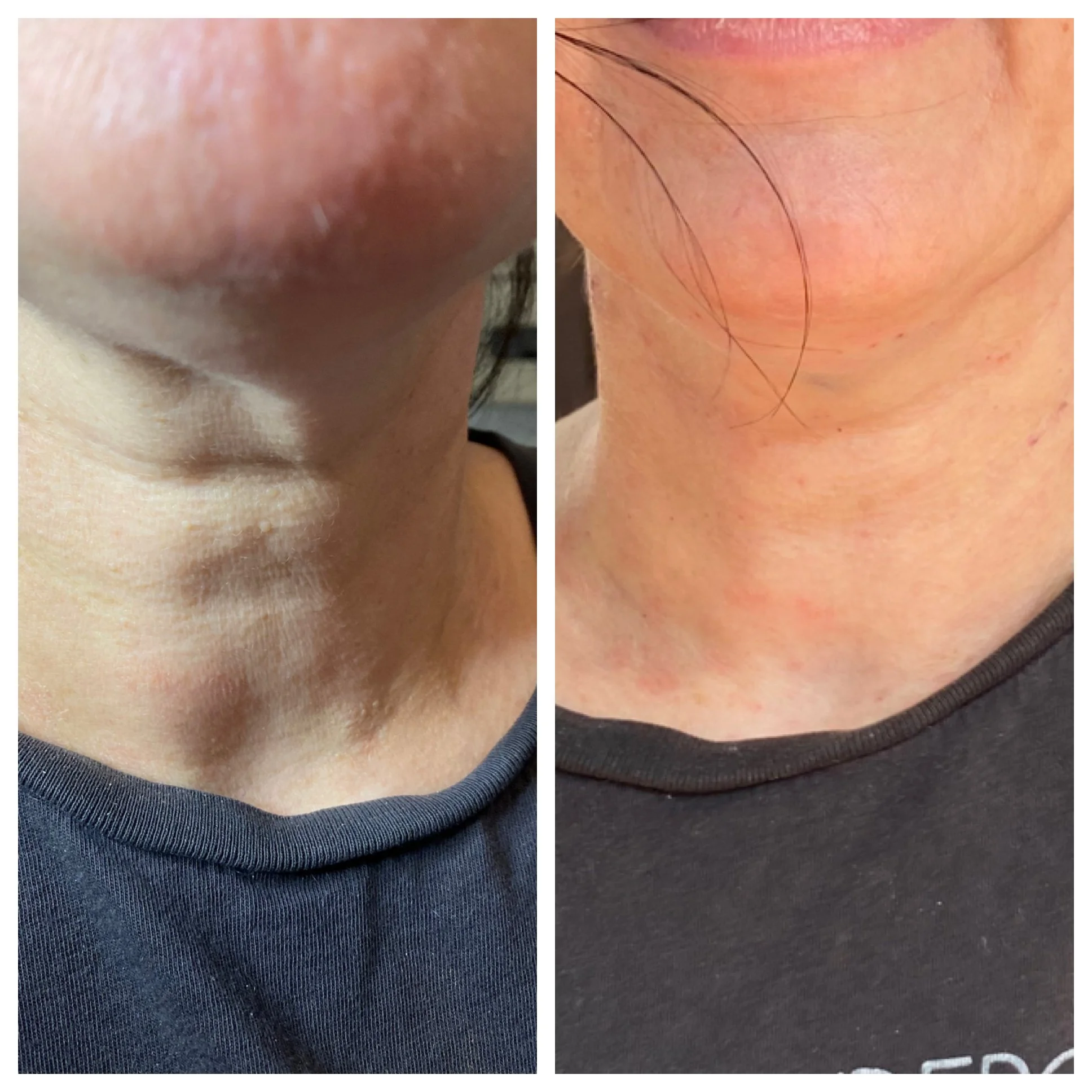 PDO Threads | Enhance Your Look Today — Dallas Medicine & Aesthetics