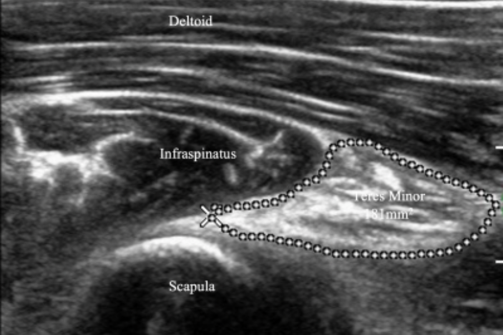 Shoulder pain 2: remember the exceptions — Sound Experience ...