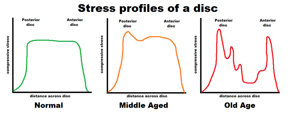 Degenerative Disc Disease — Rehab Hero