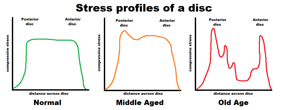 Degenerative Disc Disease — Rehab Hero