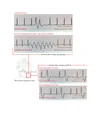 Ventricular ectopy recognition: Groupings and patterns on the ECG for ...