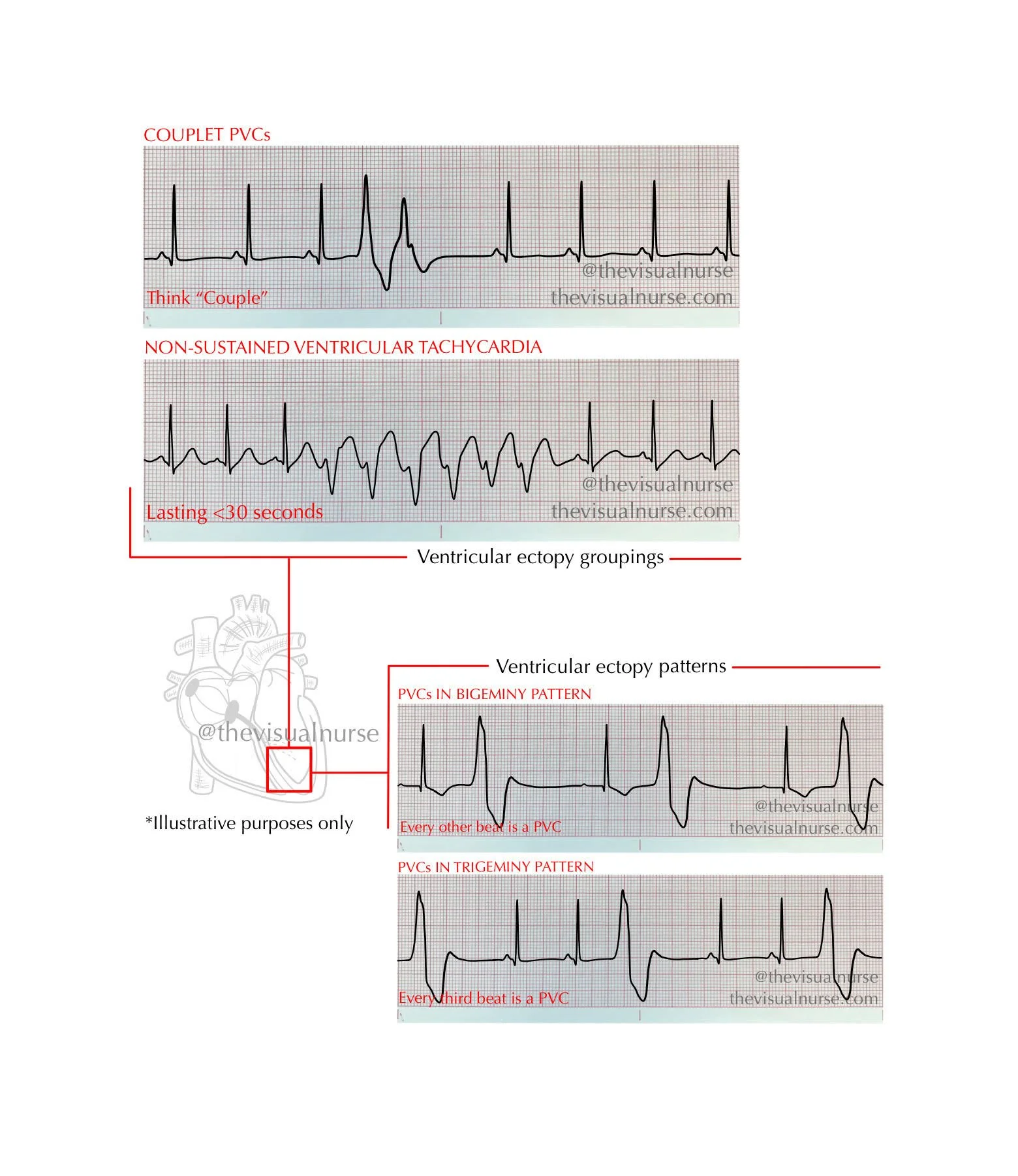 Ventricular ectopy recognition: Groupings and patterns on the ECG for ...
