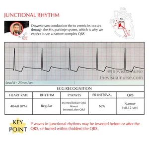 Junctional rhythm recognition on ECG for new nurses and students — The ...