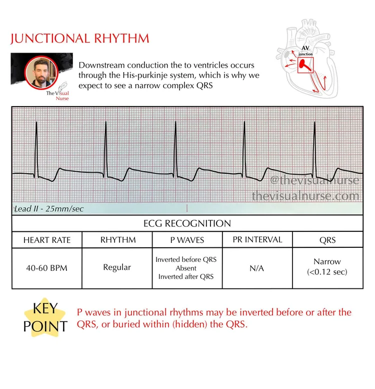Junctional rhythm recognition on ECG for new nurses and students — The ...