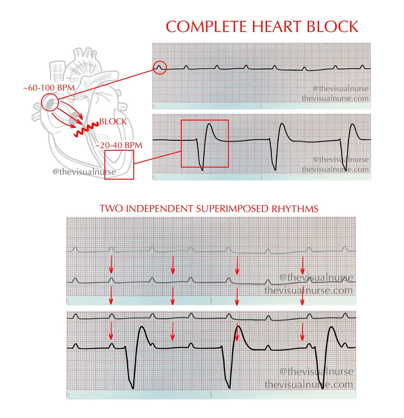 Complete heart block (third degree AV block) on ECG for new nurses and ...