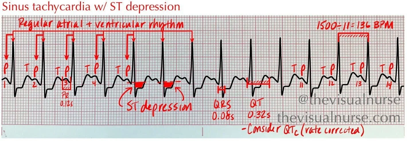 SVT on ECG: why does it have to be so confusing (for nurses & nursing ...