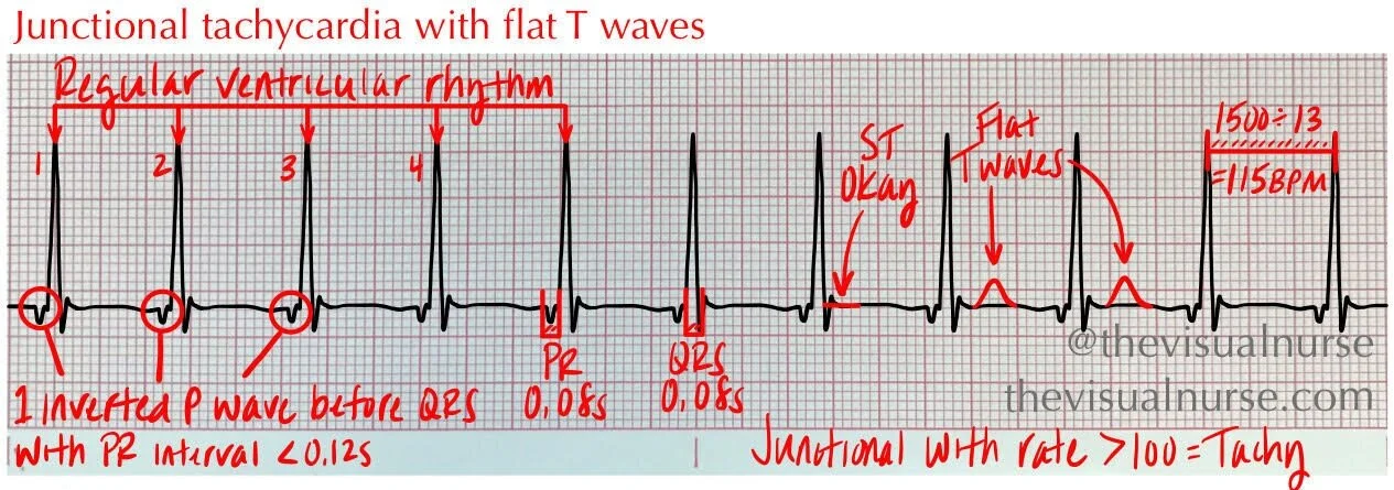 SVT on ECG: why does it have to be so confusing (for nurses & nursing ...