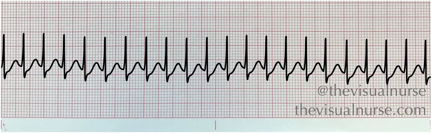SVT on ECG: why does it have to be so confusing (for nurses & nursing ...