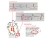 Complete heart block on ECG: why is the QRS narrow (for nurses ...