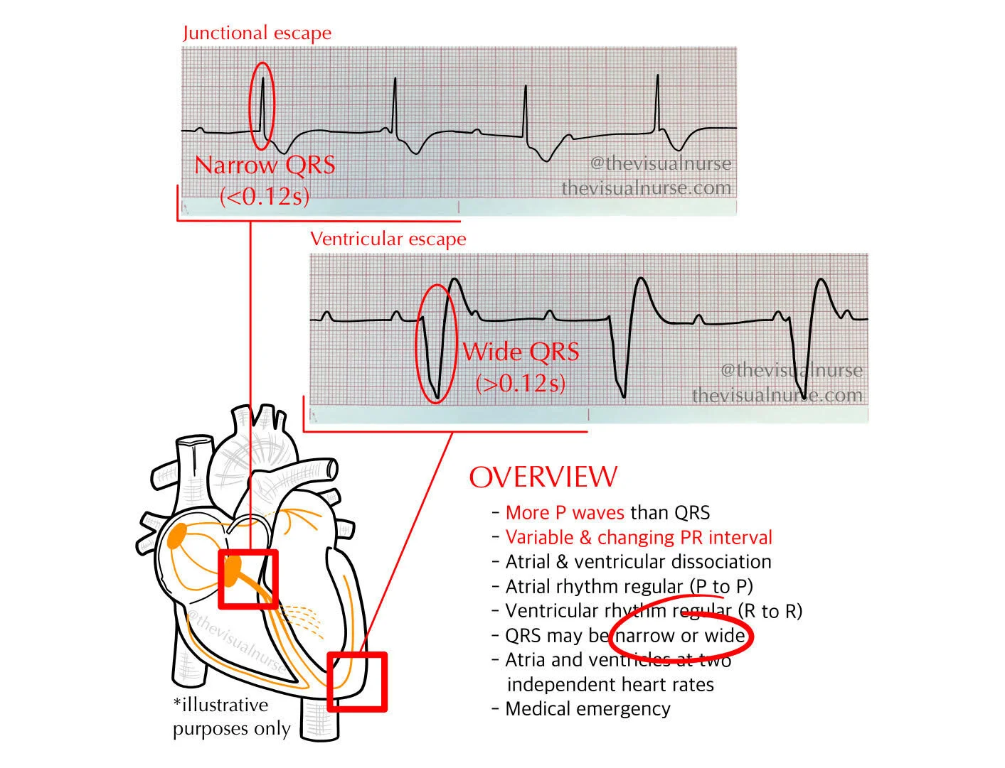 Complete heart block on ECG: why is the QRS narrow (for nurses ...