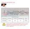 Torsades de Pointes (TdP) on the ECG for nurses & nursing students ...