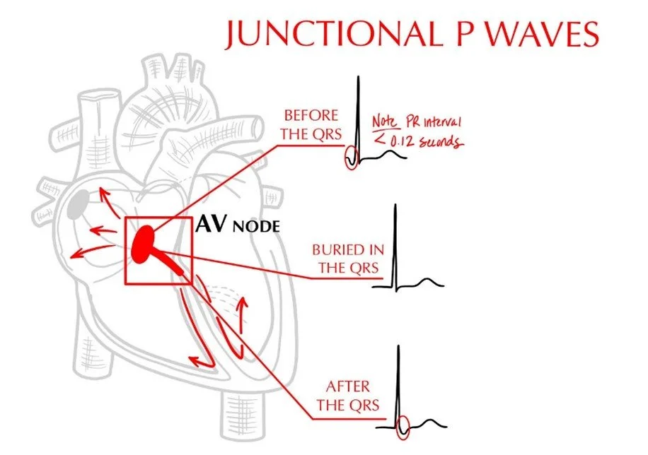 Junctional rhythm recognition on ECG for new nurses and students — The ...