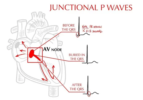 Junctional rhythm recognition on ECG for new nurses and students — The ...
