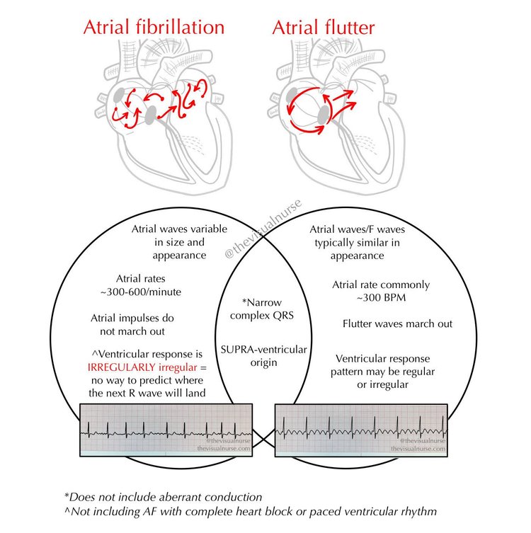 Atrial fibrillation vs. atrial flutter on the ECG for nurses & nursing ...