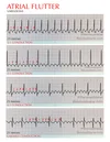 Atrial fibrillation vs. atrial flutter on the ECG for nurses & nursing ...
