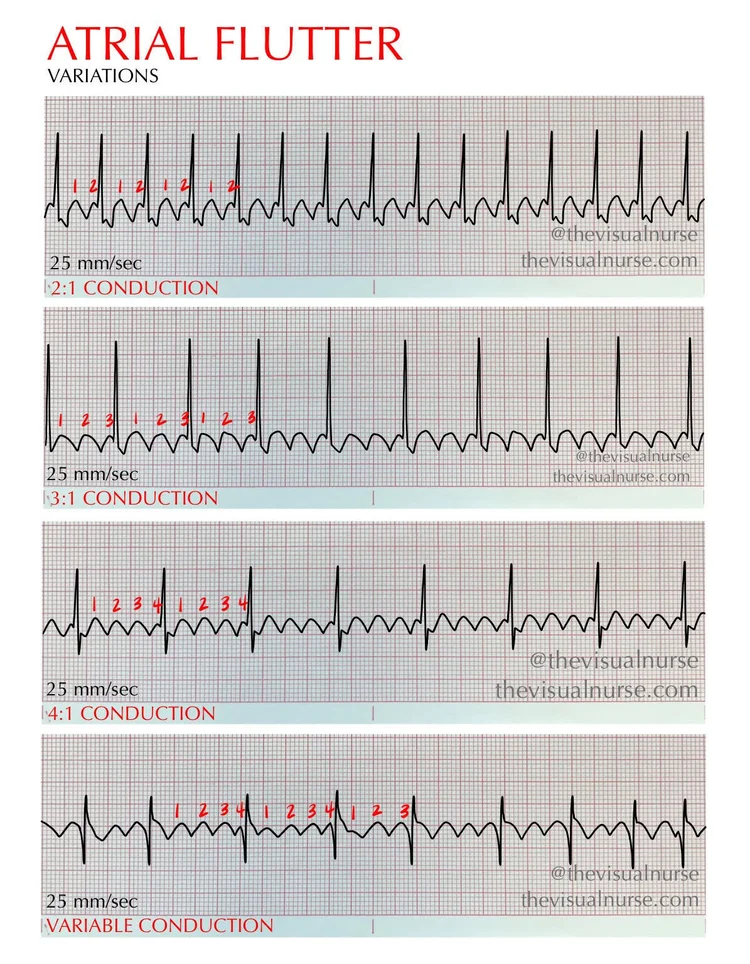 Atrial fibrillation vs. atrial flutter on the ECG for nurses & nursing ...