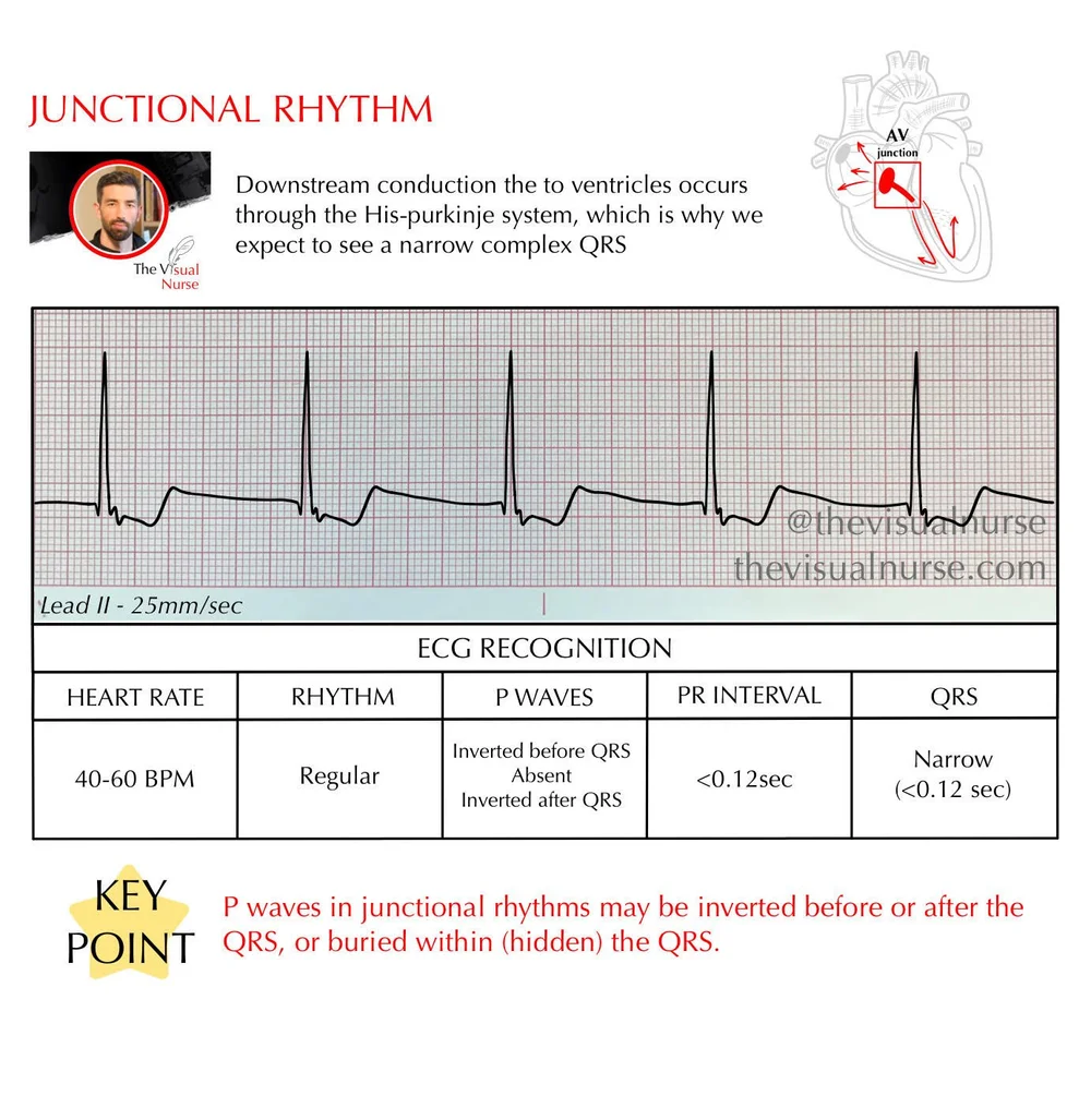 Junctional rhythm recognition on ECG for new nurses and students — The ...