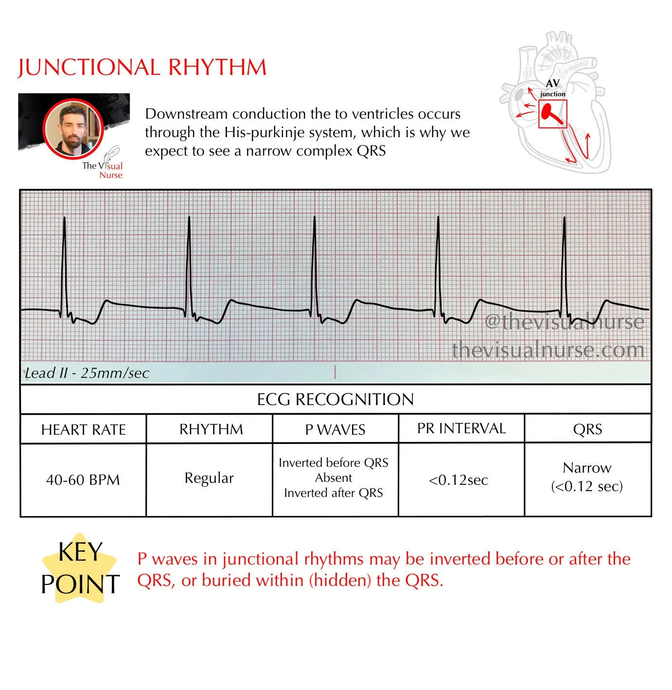 Junctional rhythm recognition on ECG for new nurses and students — The ...