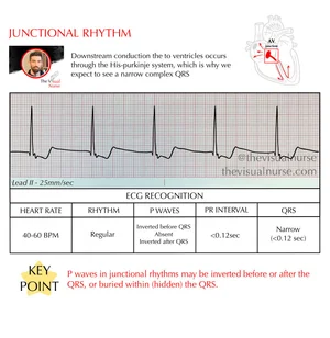 Junctional rhythm recognition on ECG for new nurses and students — The ...