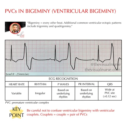 Ventricular bigeminy (PVCs in bigeminy) on ECG for new nurses and ...