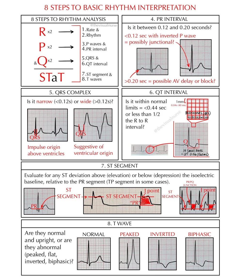 8 simple steps to basic ECG rhythm interpretation for nurses & nursing ...