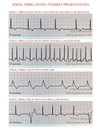 Atrial fibrillation vs. atrial flutter on the ECG for nurses & nursing ...