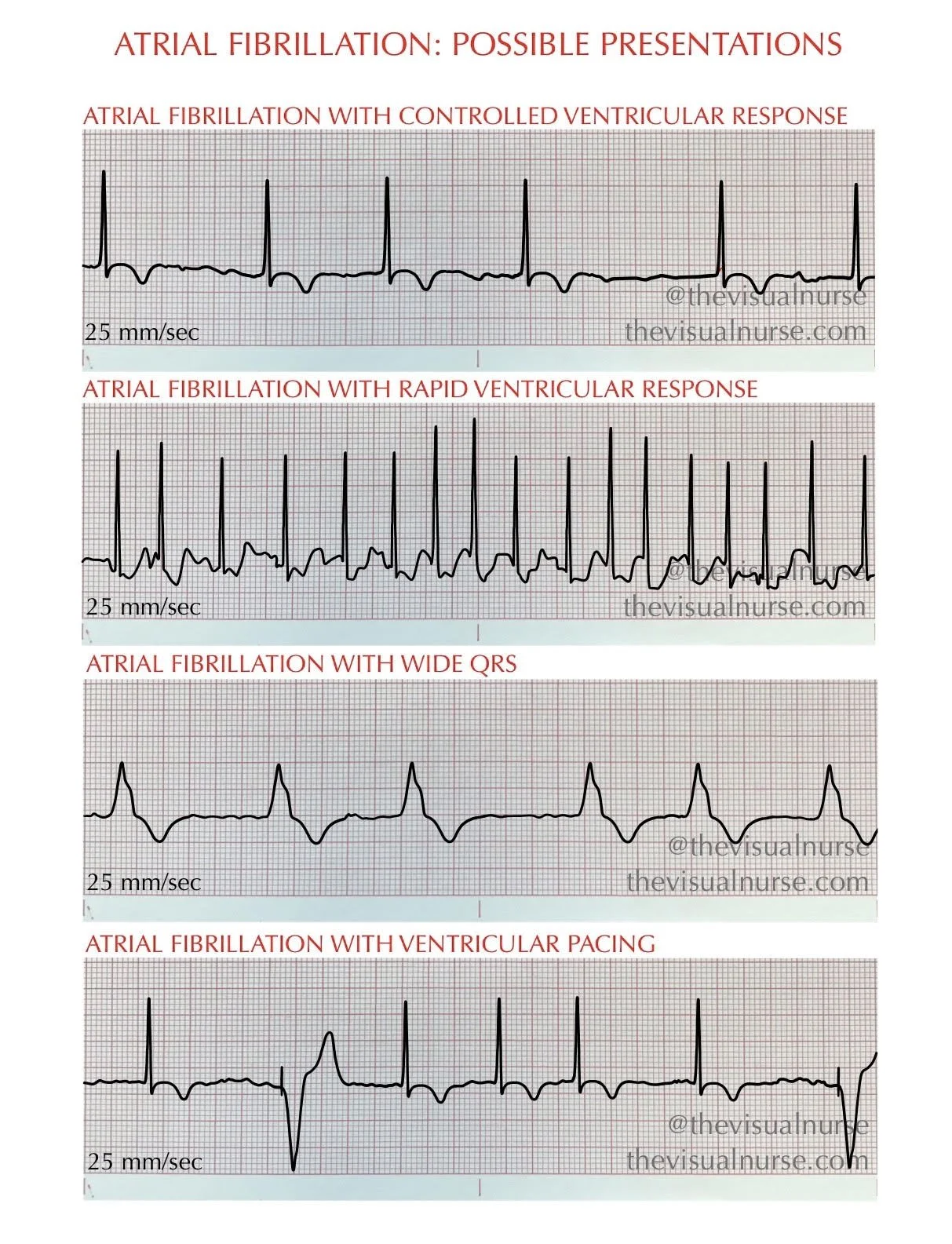 Atrial fibrillation vs. atrial flutter on the ECG for nurses & nursing ...