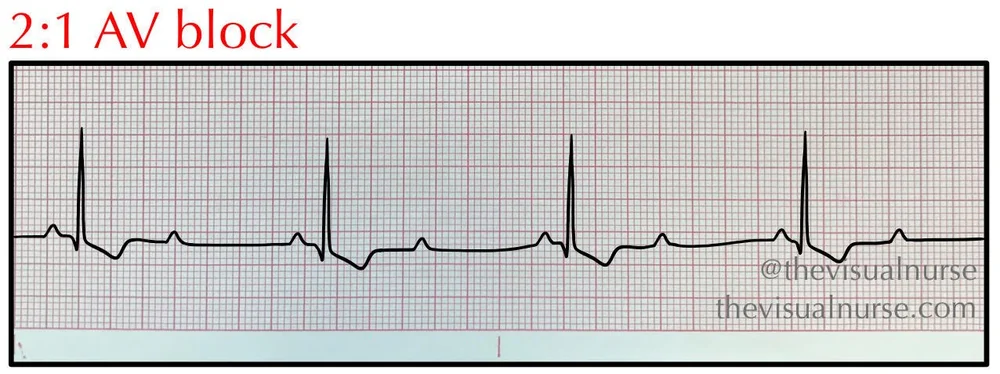 Second degree type II (Mobitz II) on the ECG for nurses & nursing ...