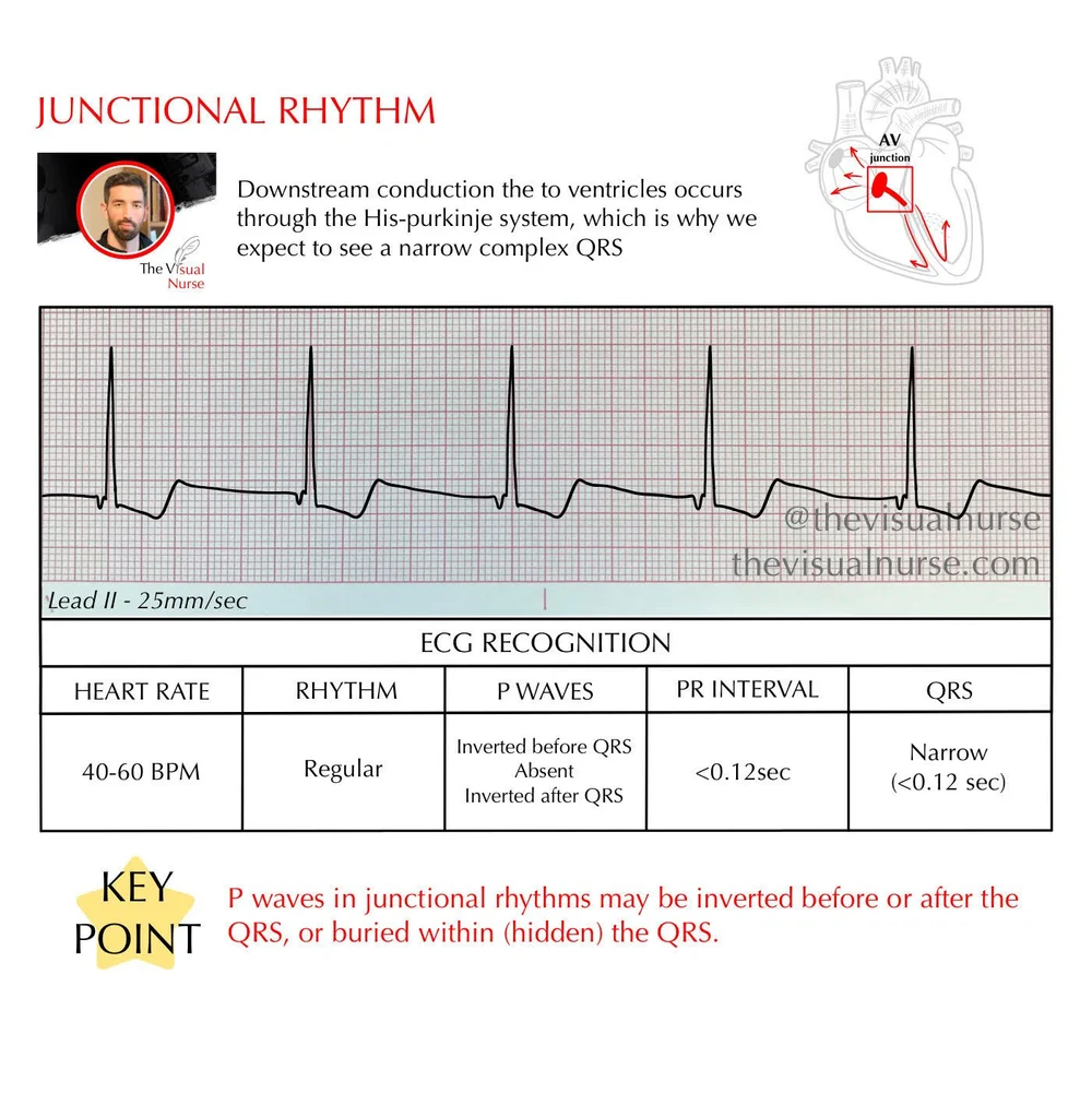 Junctional rhythm recognition on ECG for new nurses and students — The ...